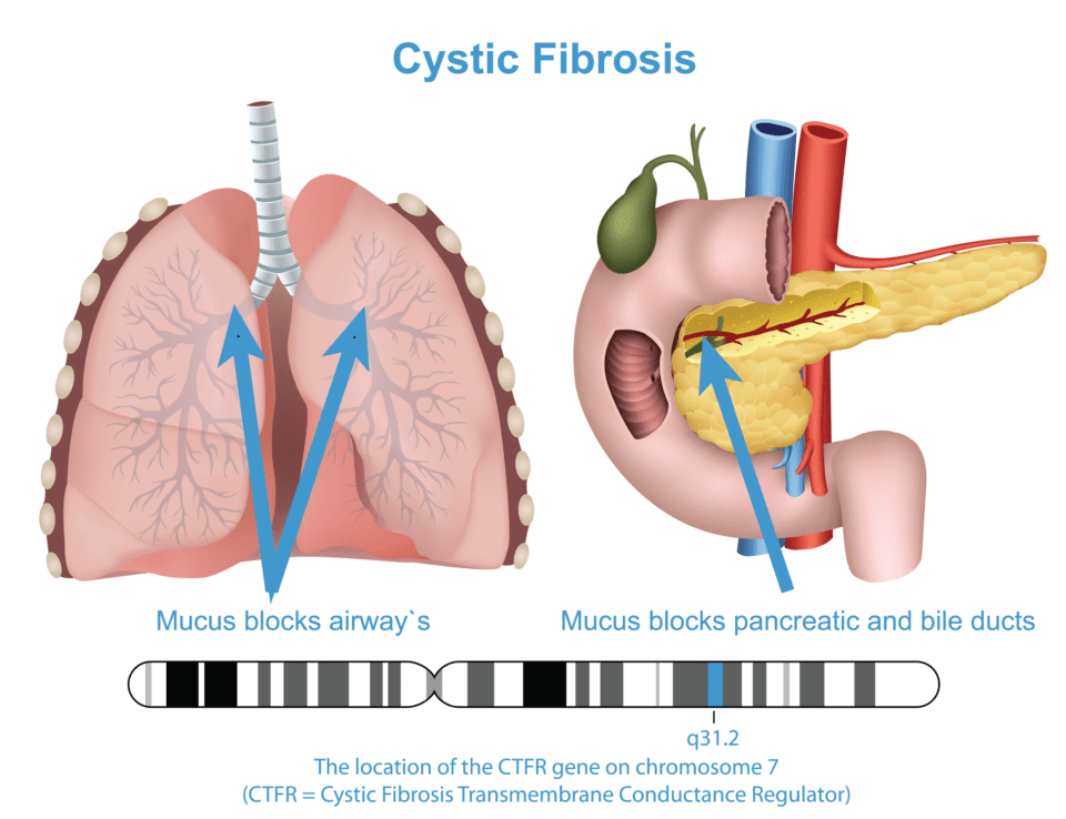 Treating Cystic Fibrosis Maxor